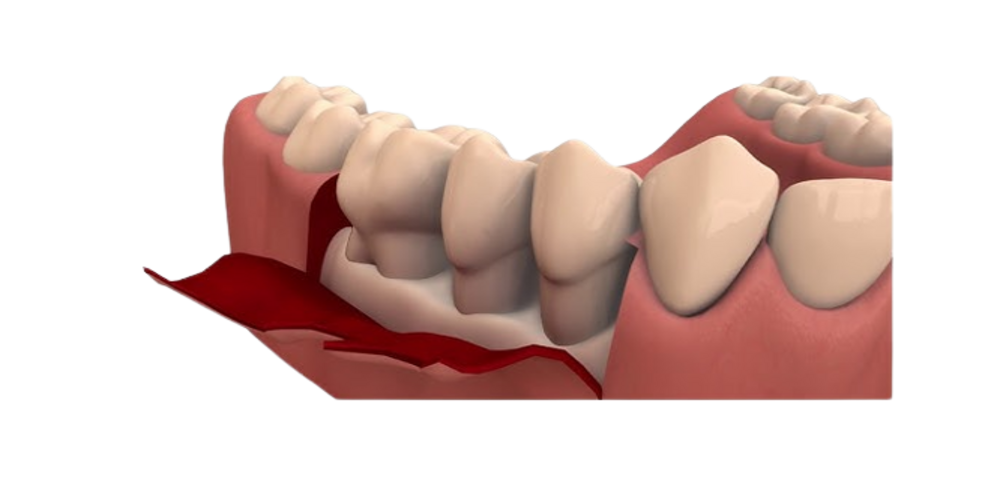 Flep Operasyonları - Mega Avrupa